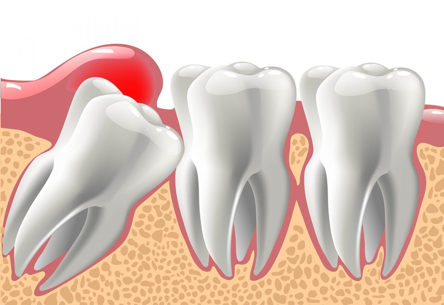Wisdom Tooth Infection: Signs, Symptoms And Treatment